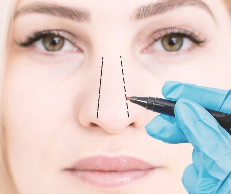 Threads Nose Job in Surat | Elegance Clinicc