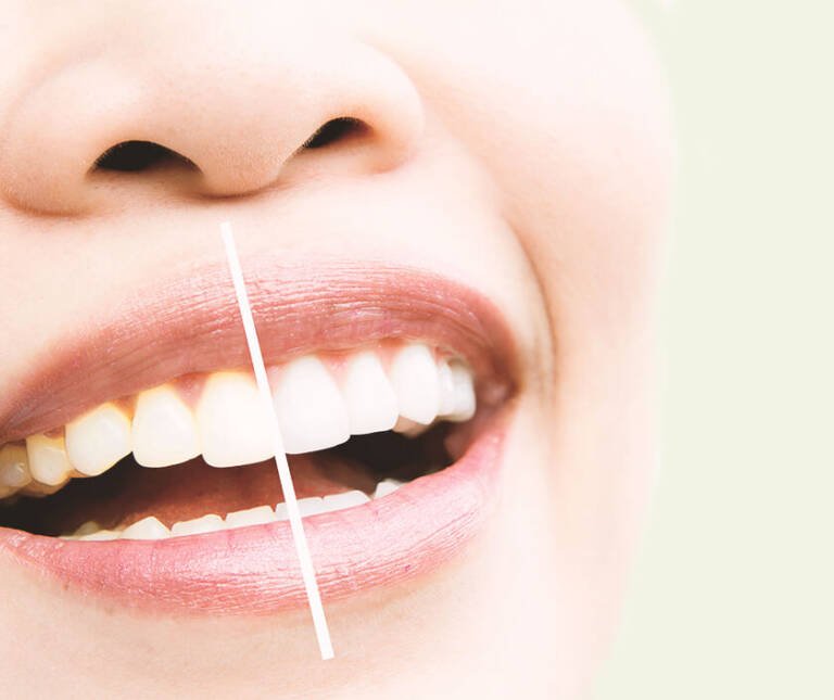 Teeth Whitening Or Teeth Bleaching - Elegance Clinic