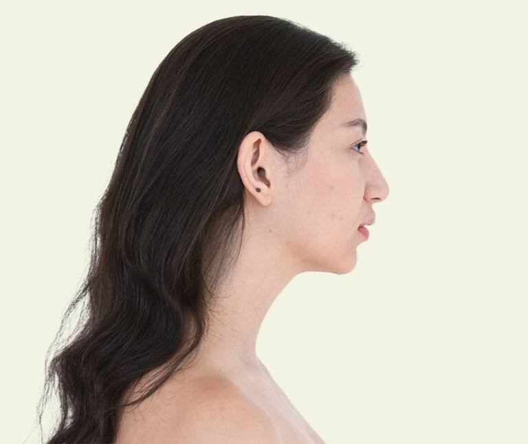 Facial Feminization Surgery In Surat Elegance Clinic
