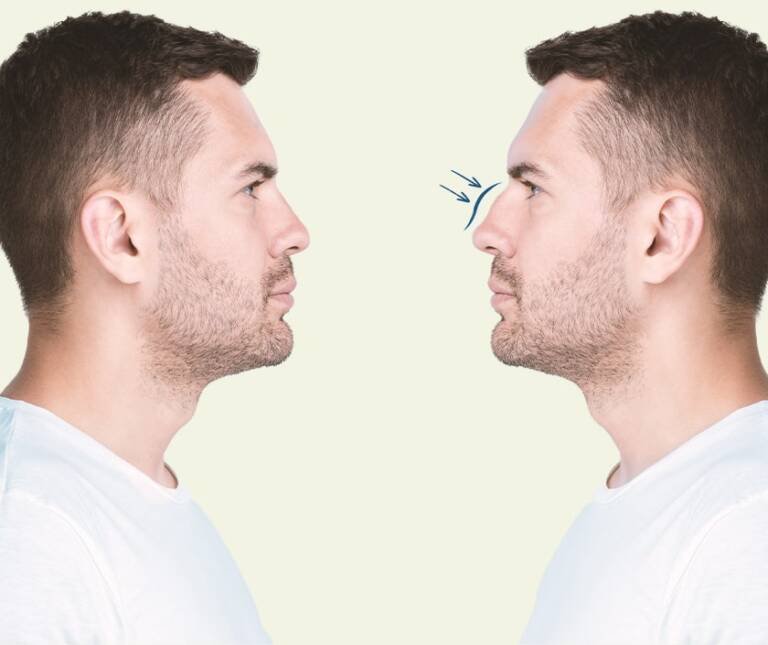 Deviated Nose Treatment in Surat | Elegance Clinic