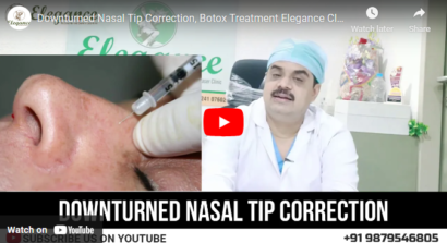 Downturned Nasal Tip Treatment in Surat | Elegance Clinic