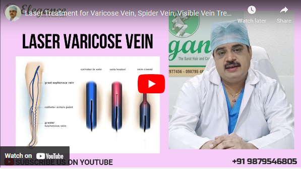 Laser Varicose Vein - Elegance Clinic