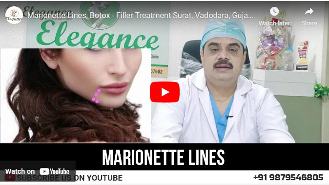 Marionette Lines Treatment in Surat | Elegance Clinic