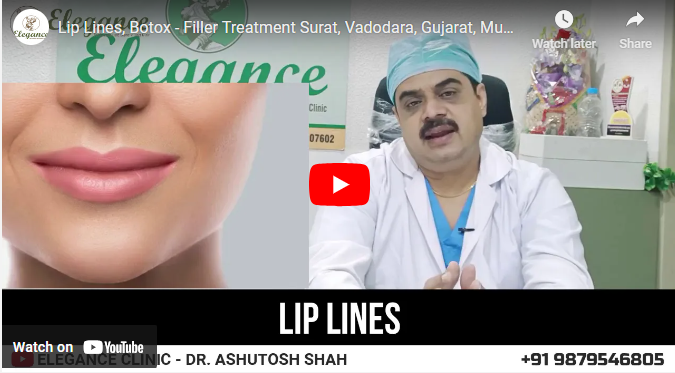 Top Lip Lines Treatment in Surat | Elegance Clinic