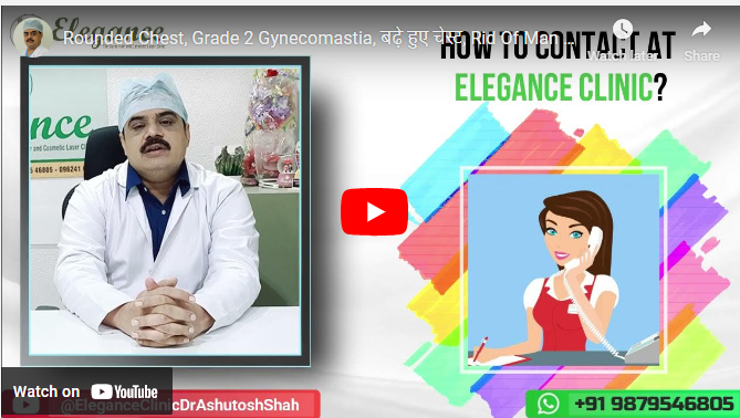 Type 2 Gynecomastia Treatment in Surat | Elegance Clinic