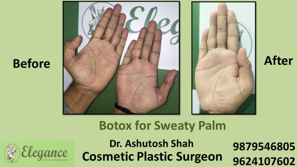 Sweaty Palms Treatment in Surat | Elegance Clinic